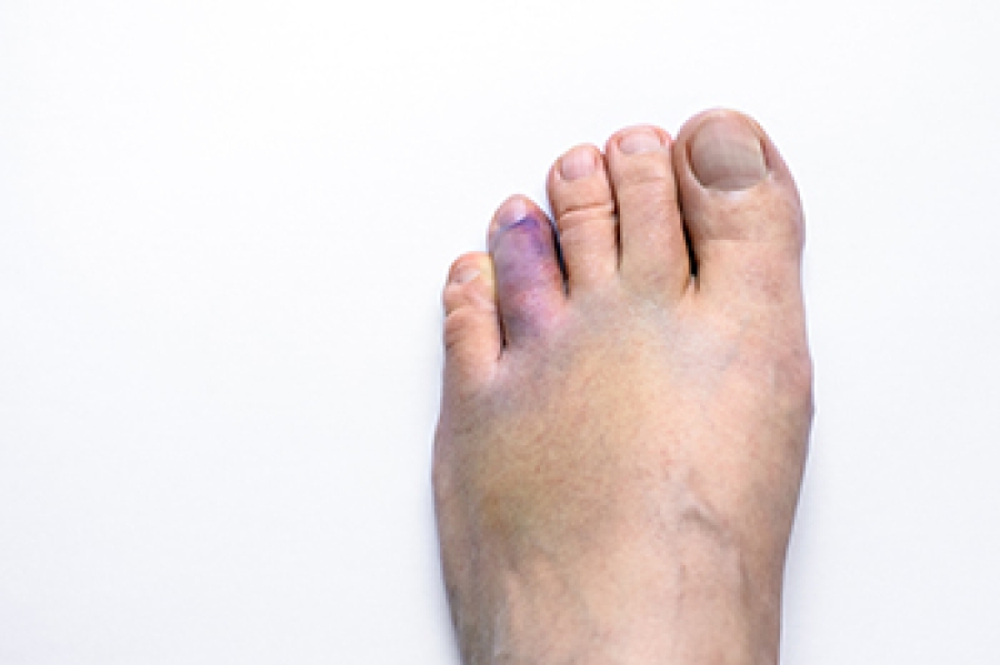 Differences Between Bruised and Broken Toes